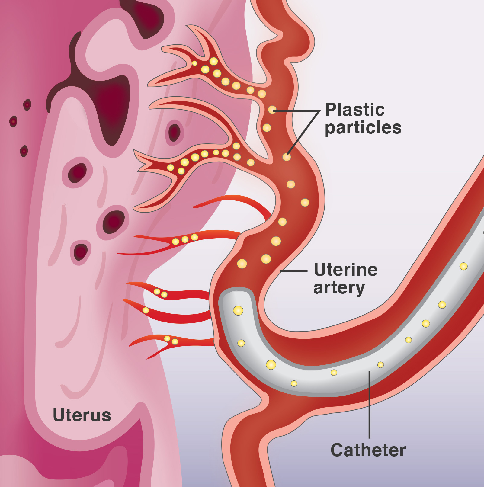 Uterine Artery Embolization FAQs - Sydney Fibroid Clinic